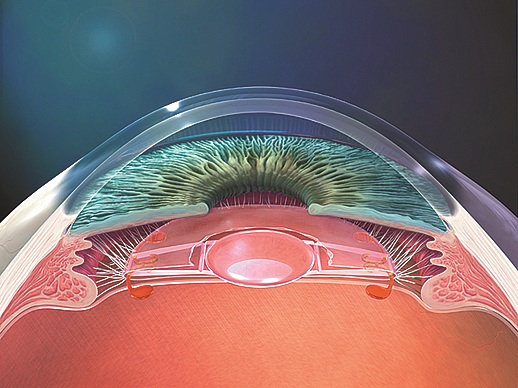 chirurgie-operation-cataracte-phakoemulsification-implant-accommodatif ...