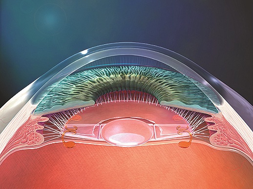 chirurgie-operation-cataracte-phakoemulsification-implant-accommodatif ...