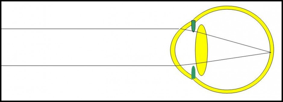 Anomalies de la Vision - L'oeil normal