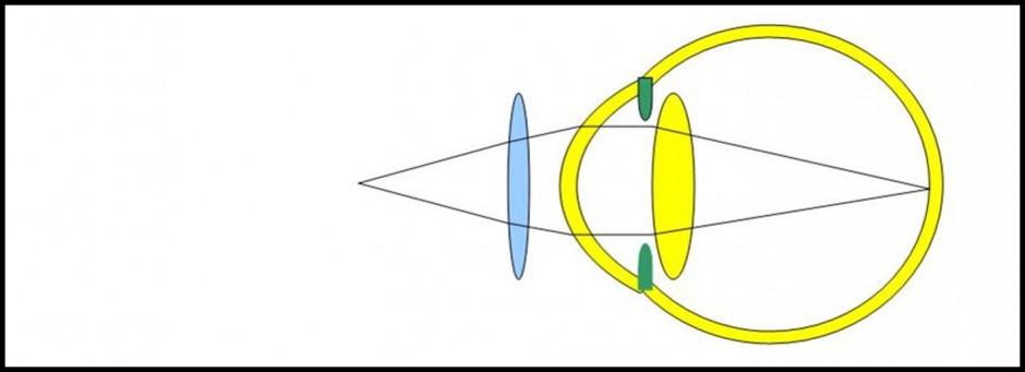 Anomalies de la Vision - Presbytie